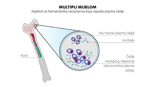Šta je multipli mijelom? | Janssen With Me