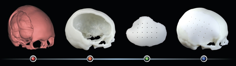 PEEK empowers custom-designed skull implants