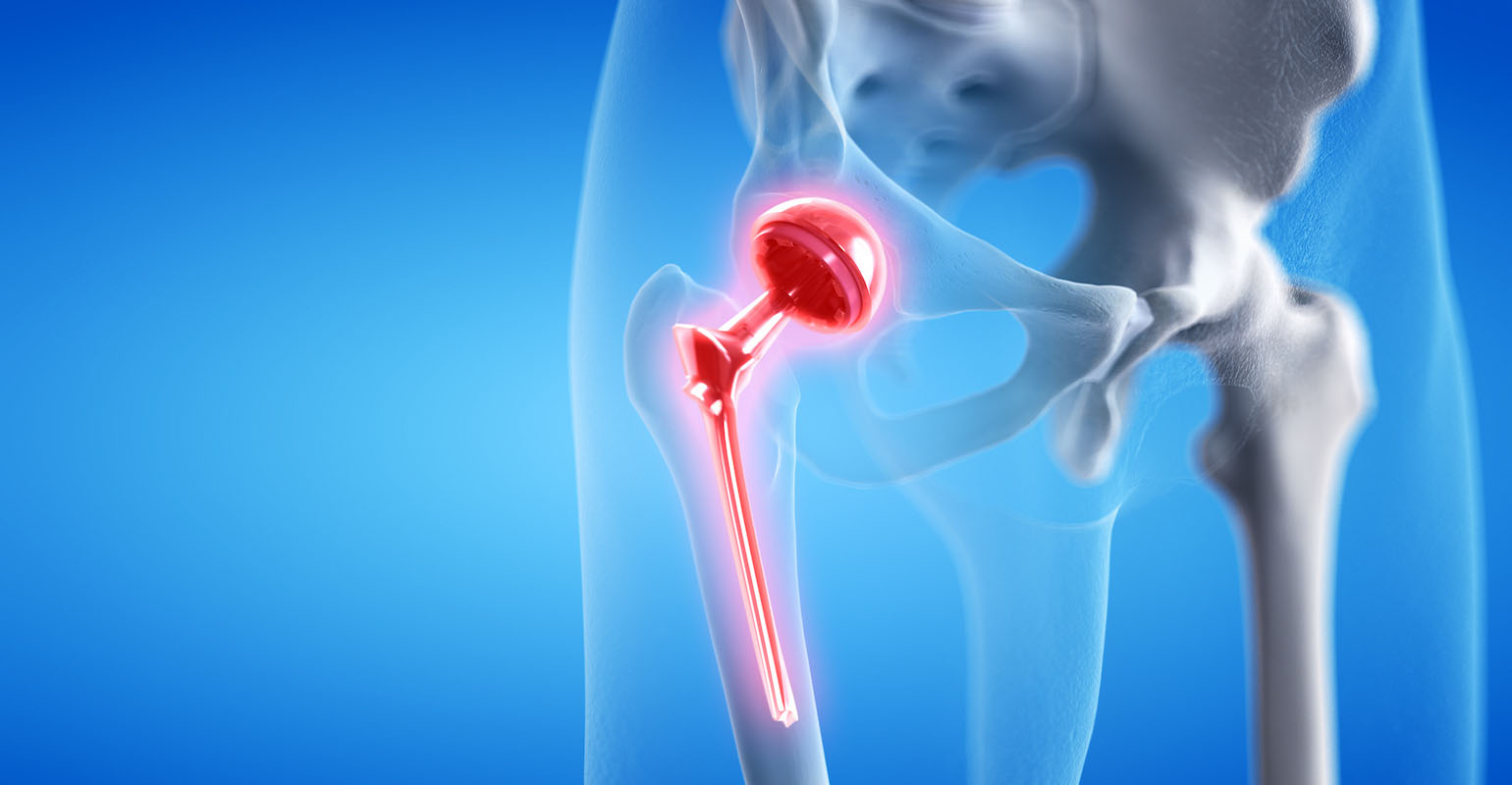 Polymer Coating ‘Hooks Up’ Implants with Human Bones