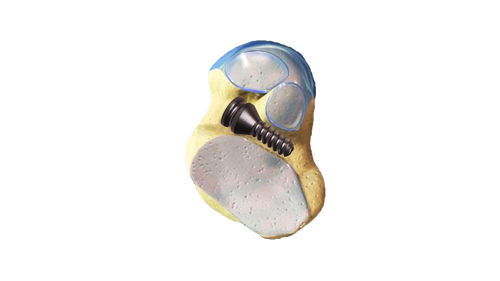 Digitized Manufacturing is the New Wave of Medical Implant Design