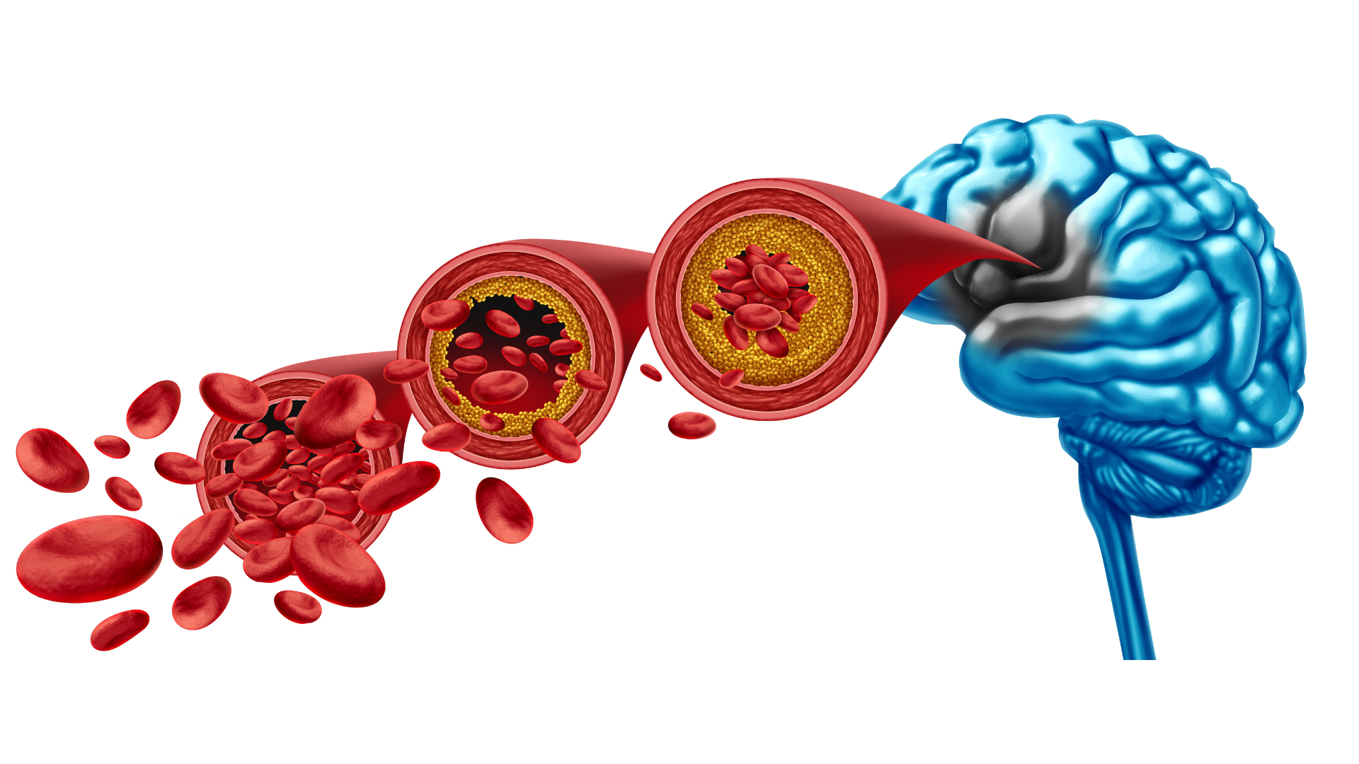 Boston Scientific Catches Lightning in a Bottle with Penumbra
