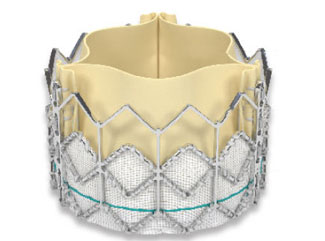TAVR: Still the Next Big Thing in Cardiology?