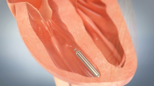 St. Jude Medical Buys Leadless Pacemaker Developer Nanostim For $123.5
