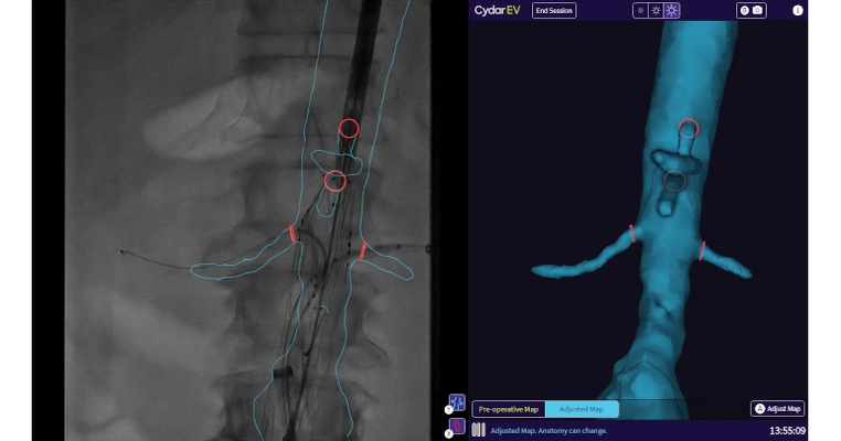 Can Cloud-Based AI & Computer Vision Improve Endovascular Surgery?