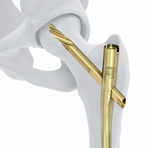 J&J Beefing Up Device Product Pipeline: TFN Advanced Proximal Femoral