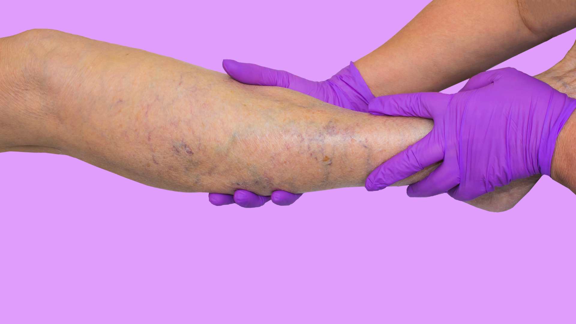 The Evolution of Chronic Venous Insufficiency Treatment