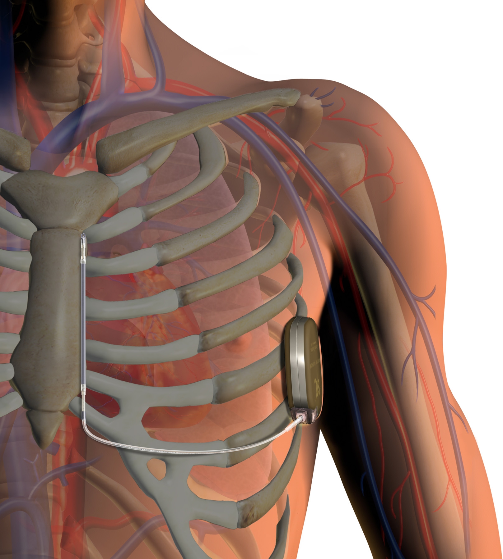 Subcutaneous Icd