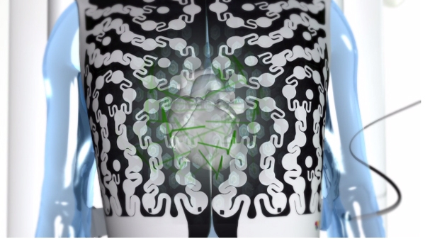 What Medtronic Bought on Its $1 Billion Shopping Spree