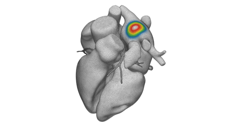 Vektor Updates vMap Software for Cardiac Arrhythmia Mapping