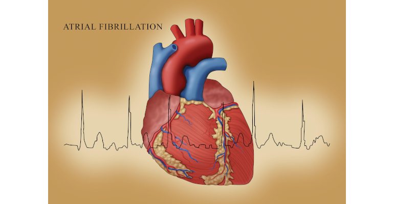 Could Vagal Nerve stim reduce postop Afib?