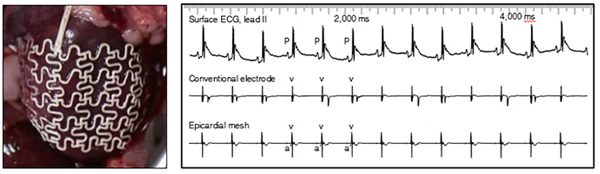 Preventing Heart Attacks With an Electromechanical Hug
