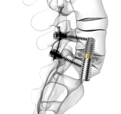 Can This Spinal Fusion Technology Rise from the Ashes?