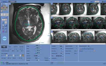Insightec’s Ultrasound Tech Wins FDA Nod as Essential Tremor Treatme