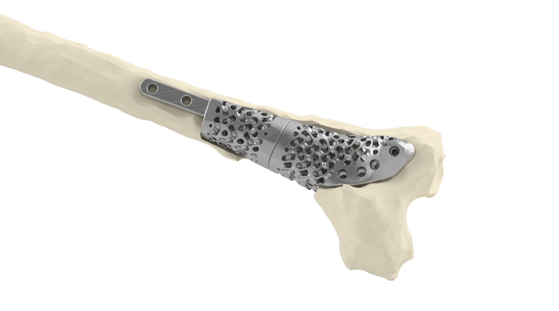 OsseoLabs’ Custom 3D-Printed Implants Enhance Outcomes & Buffer Tariffs