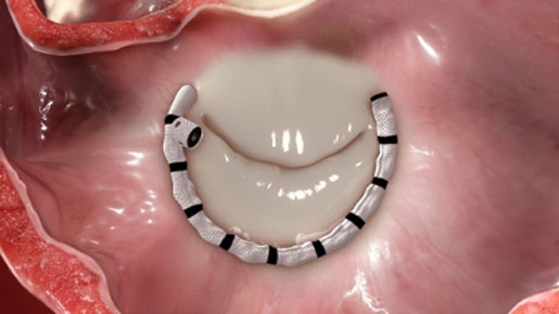 Edwards Doubles Down on Transcatheter Mitral Valve Therapies