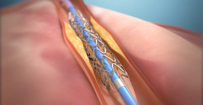 New Bioadapt Implant Exceeds Expectations for Vessel Restoration