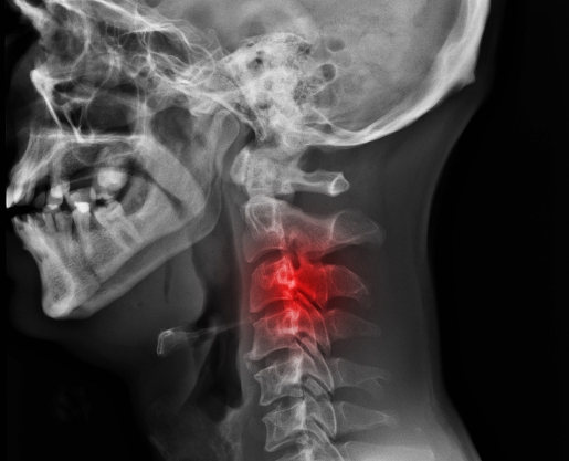 New Bone Graft Aims to Make Fusions of the Neck Stronger