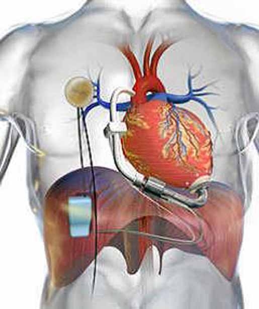 9 Promising Cardio Technologies: Wireless LVADs