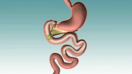 CE Mark Suspension Adds Insult to GI Dynamics' Injury