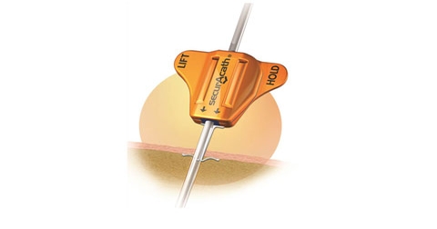 Interrad Medical Sees Opportunity in Securing Catheter Lines