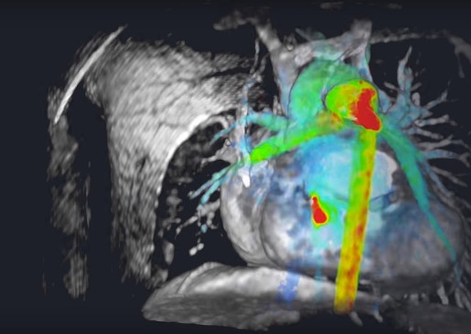 Startup Partners With GE to Provide Blood Flow Visualization in Cardia