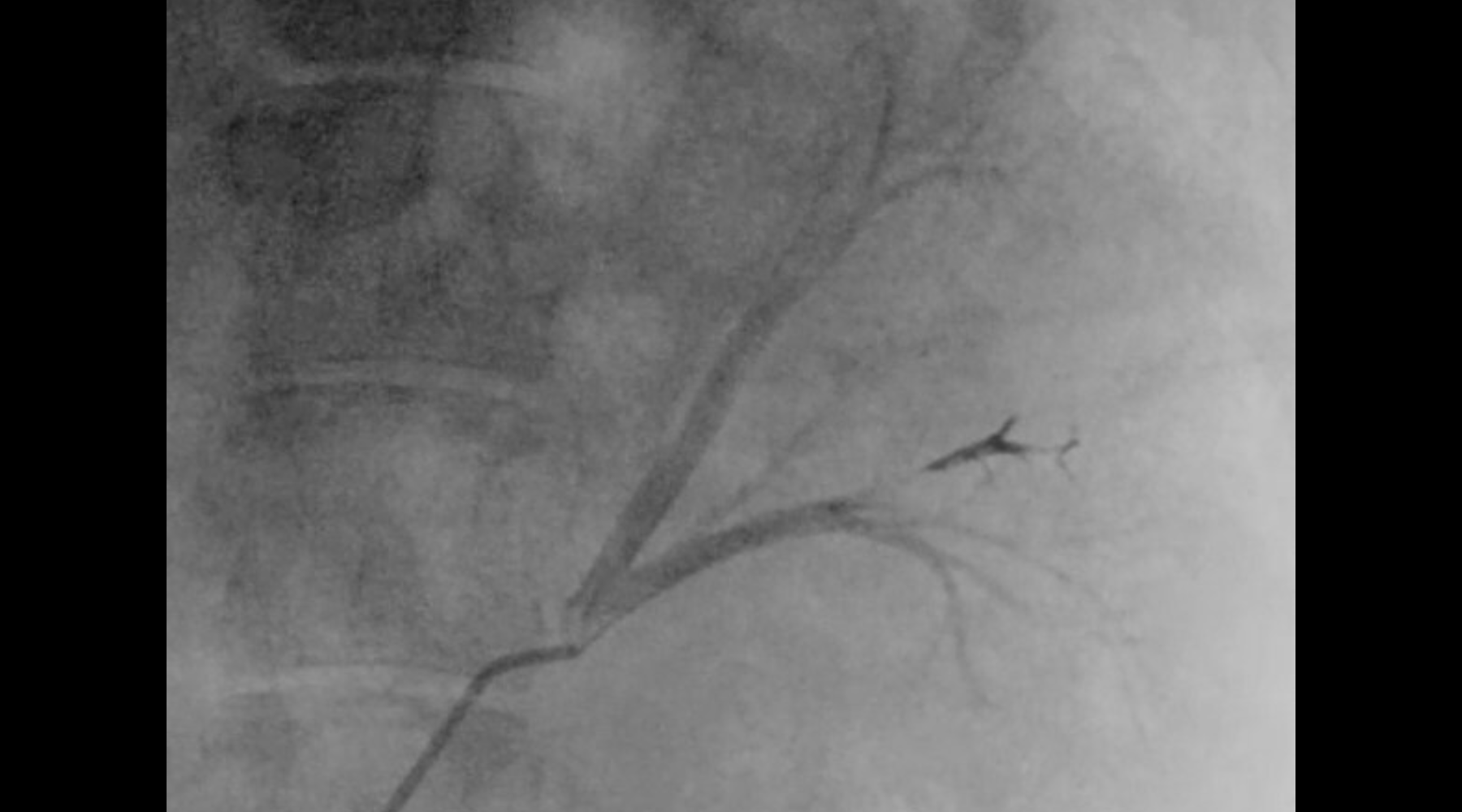 Fluidx Medical Introduces New Ultra Embolic Platform