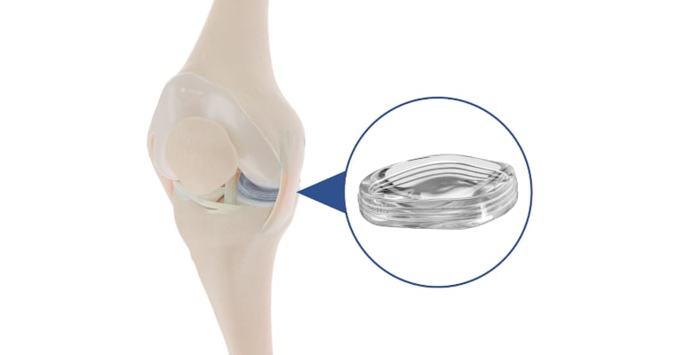 Artificial Meniscus Aims to Fill Treatment Gap to Provide Pain Relief
