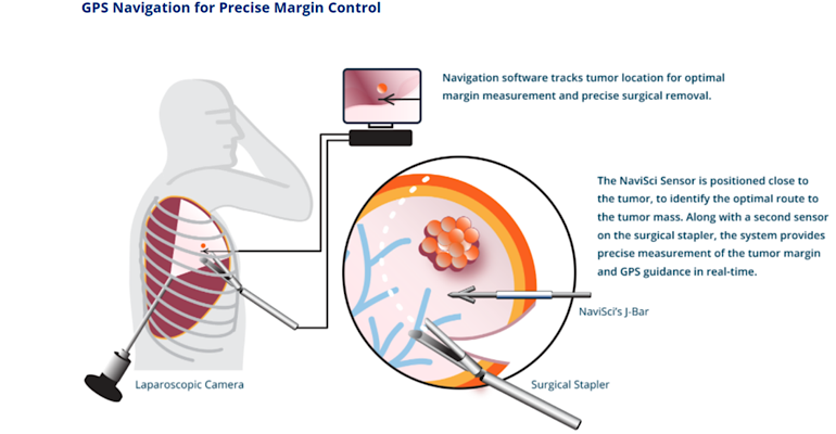 Navigating Through Early-Stage Lung Cancer