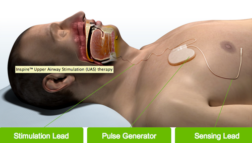 Inspire Medical Wins Battle to Bring First Implantable Sleep Apnea De