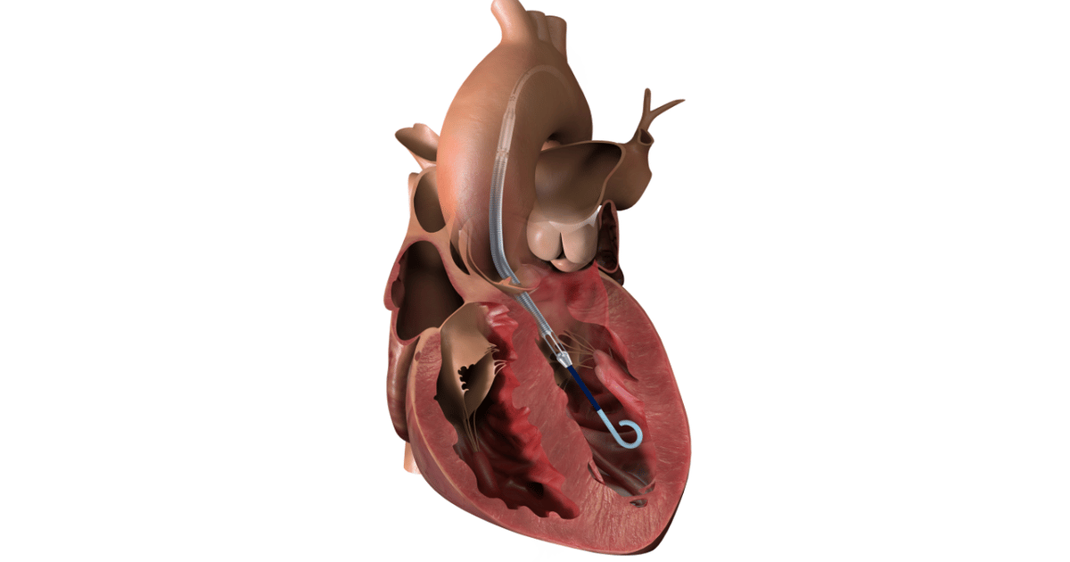 J&J Recalls Impella CP Heart Pumps Over Design Flaw