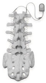 Harmful Chemicals in Spine Implants Prompt Zimmer Recall