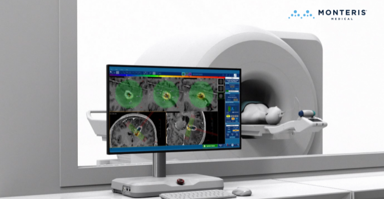 This Surgical Alternative for Recurrent Glioblastoma Is LITT