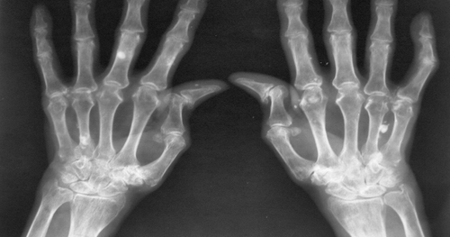 AI may help detect ‘occult’ bone fractures that are invisible to humans ...
