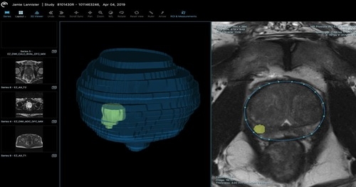 FDA clears AI-based system for detecting prostate cancer | AI Business