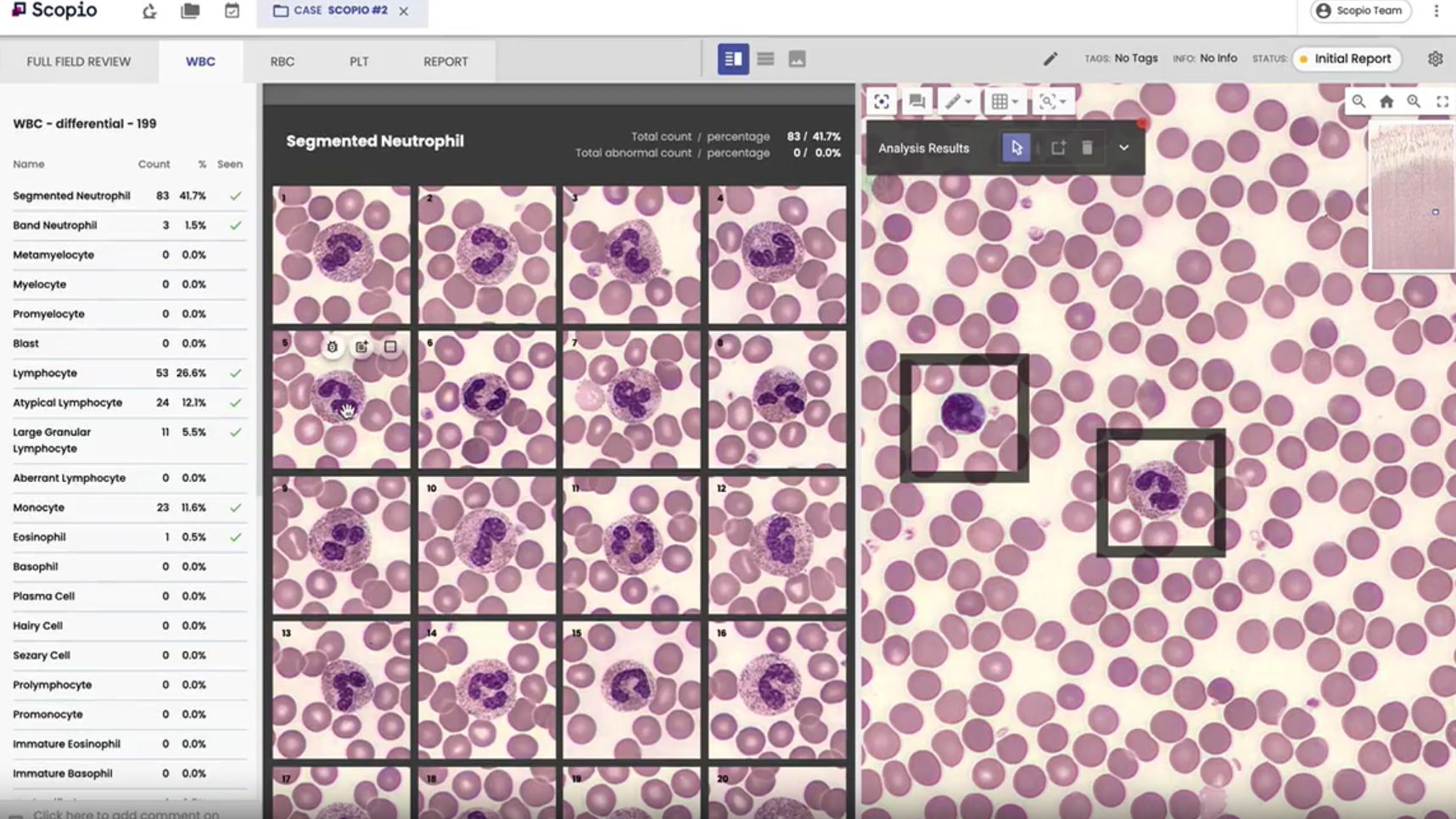 FDA Clears AI Tool for Detecting Cancer Signs in Bone Marrow
