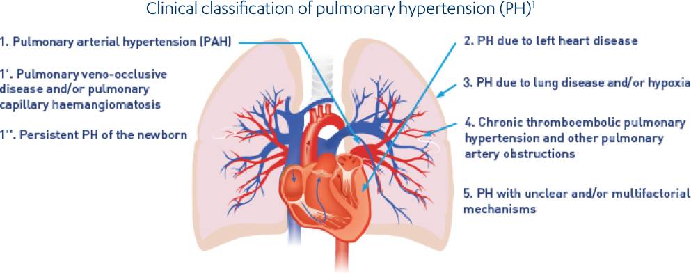 Pathophysiology of pulmonary arterial hypertension | Janssen