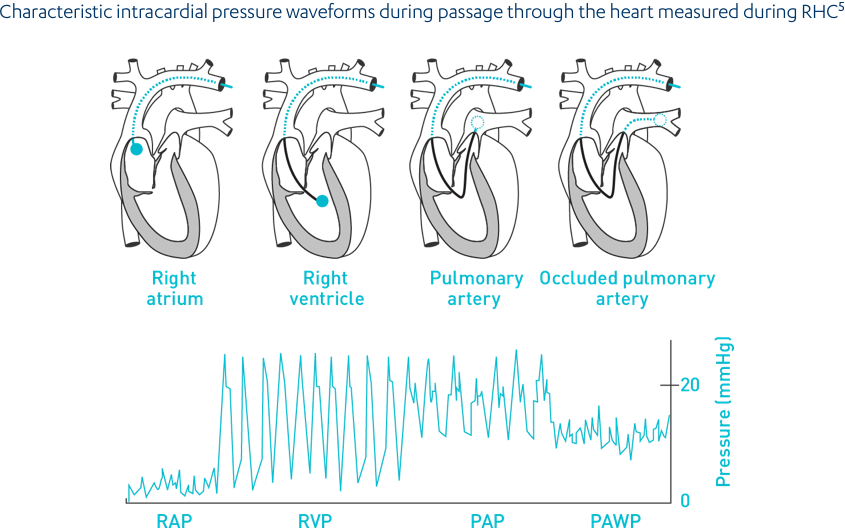 The diagnosis of pulmonary arterial hypertension | Janssen