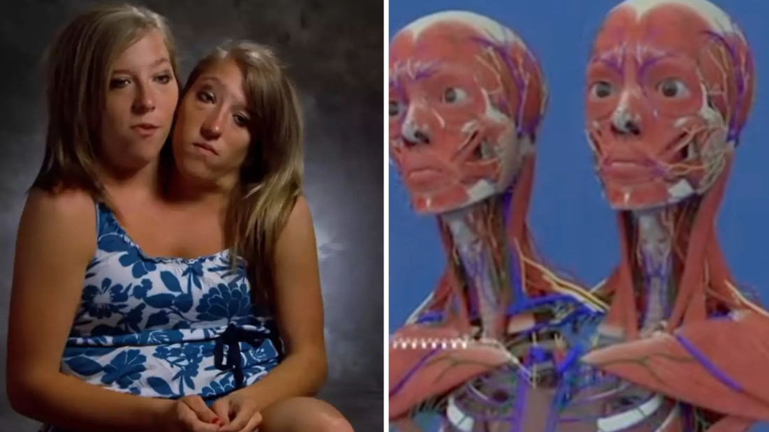 What Is The Tragic Story Of Conjoined Twins Abby And Brittany