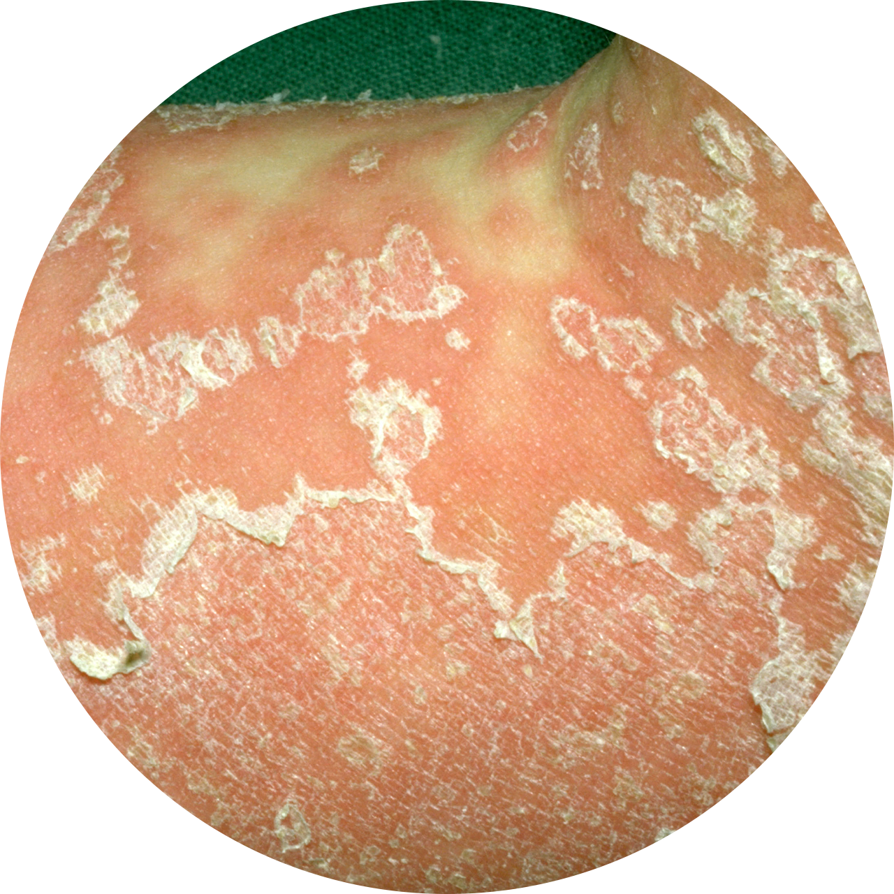 Schuppenflechte (Psoriasis) Formen | J&J withMe