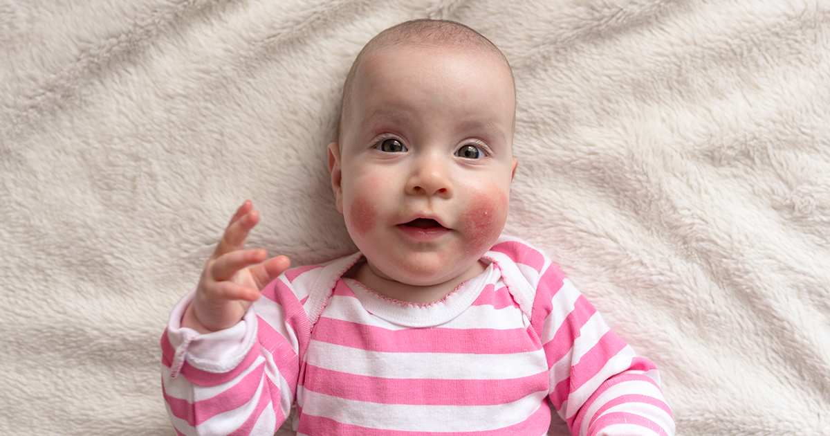 Why Is My Baby's Face Red? | Enfamil