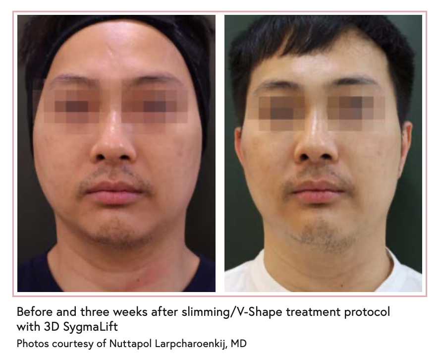 Evolved SygmaLift 3D Reshapes the Facial Contouring Landscape