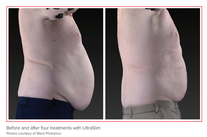 LED-Based Body Contouring Therapy Merges Aesthetic and Wellness ...