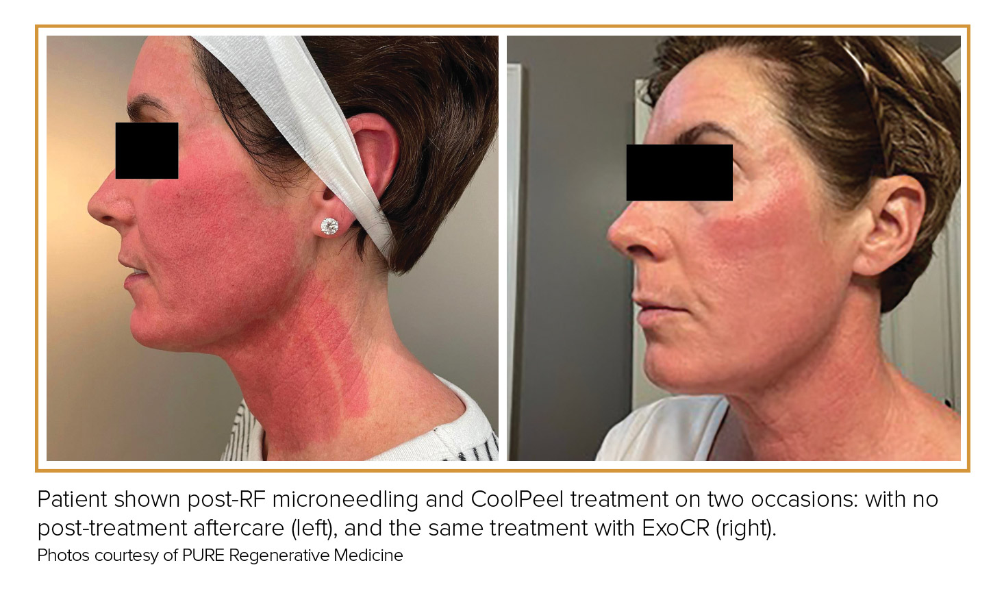 Topical Exosomes Optimize Overall Treatment Experience