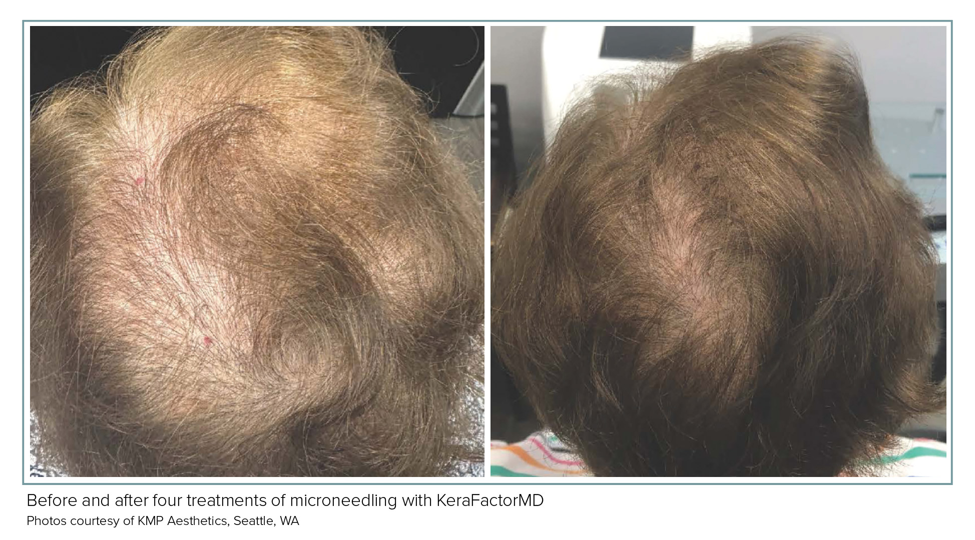 Hair System Delivers Consistent Results, Comfortable Treatment