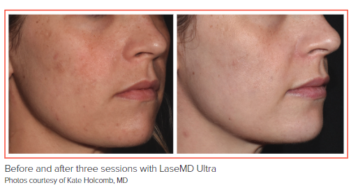 Powerful but Gentle Next-Generation Laser Therapy