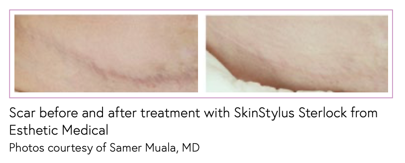 Updates in Microneedling