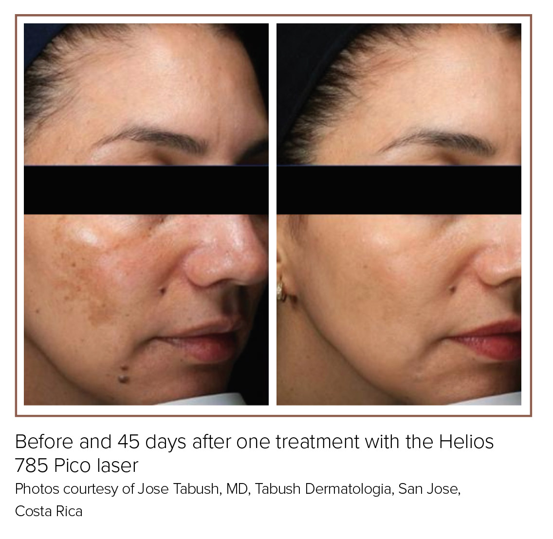 Pico + Nano Combo Laser Equals Versatility, Efficacy, Safety