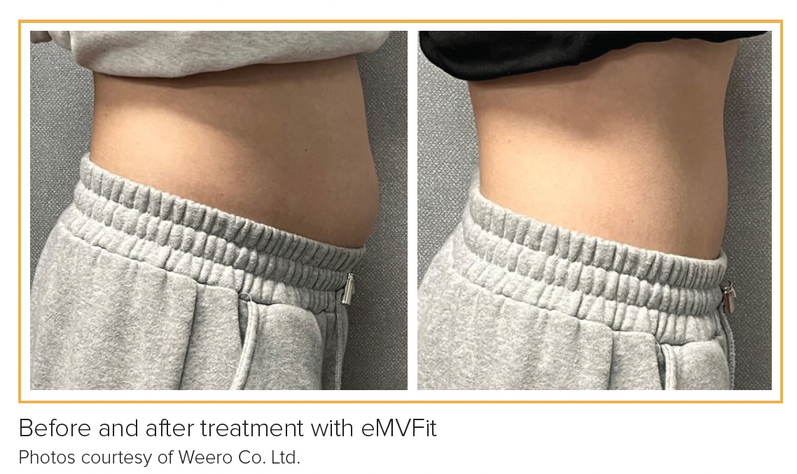 Body Contouring Device Combines Technologies for Personalized Treatment ...