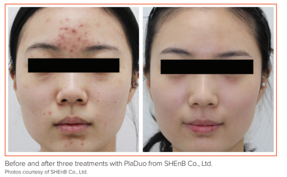 Energy-Based Devices: The Mainstays of Aesthetic Practices