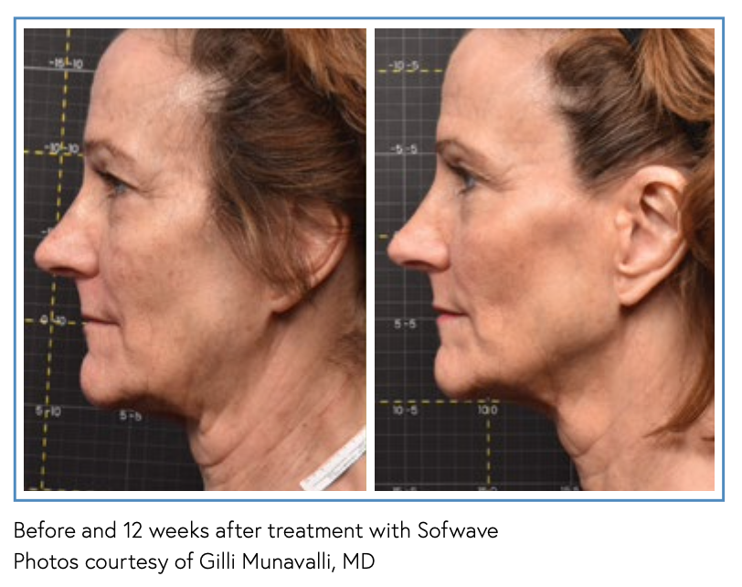 Sofwave Gets High Marks for Non-Invasively Lifting Eyebrow, Submental ...